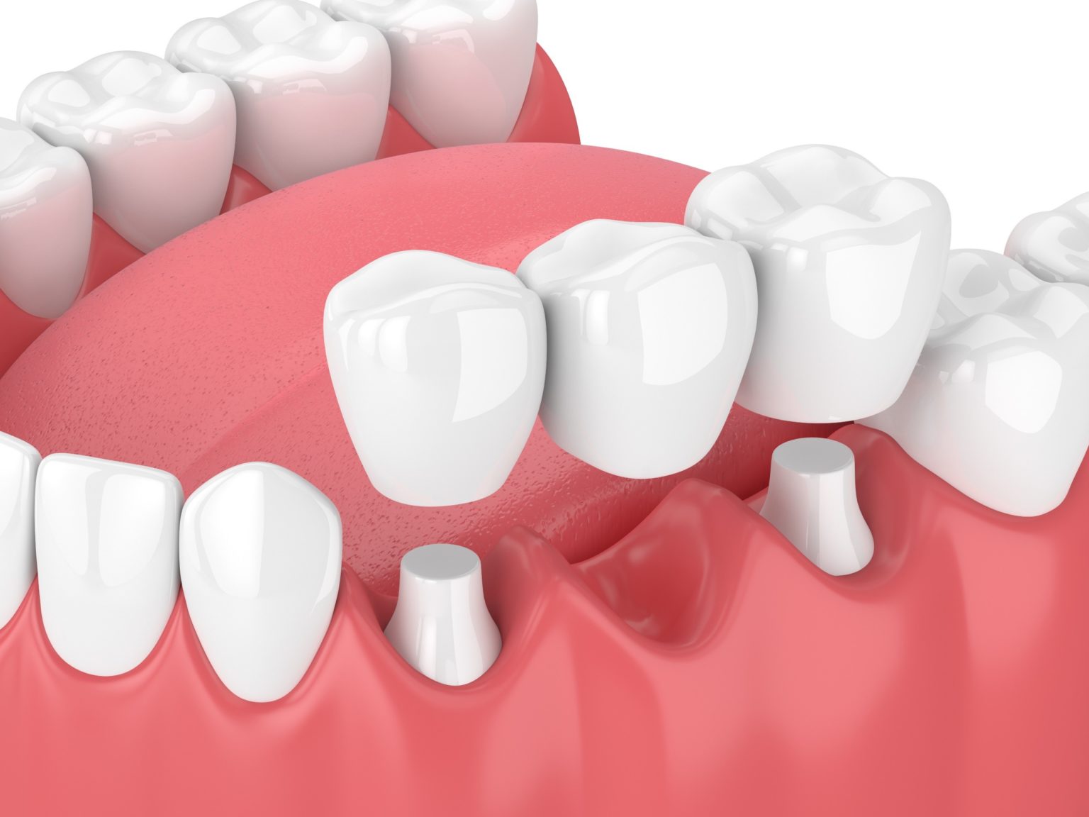 5 Mistakes That Can Cause Dental Bridge Failure